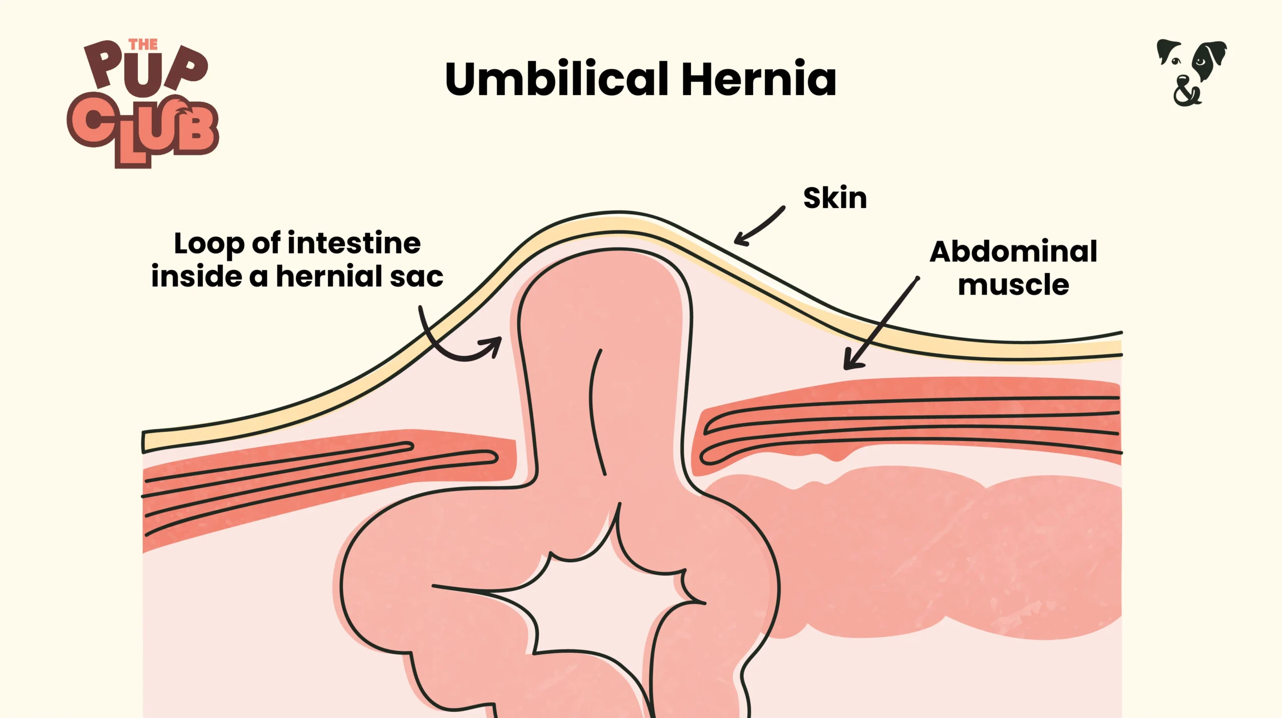 Hernia Disease A Simple Guide